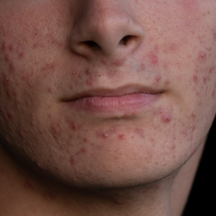 Acne — The Retouching Series